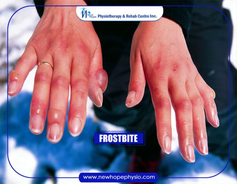 Winter Injuries and Treatment in Ontario - New Hope Physiotherapy