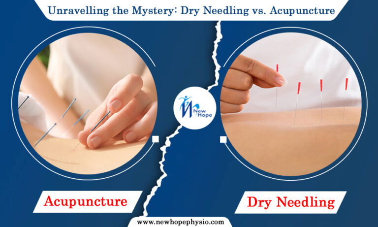 Dry Needling vs. Acupuncture: Understanding the Key Differences